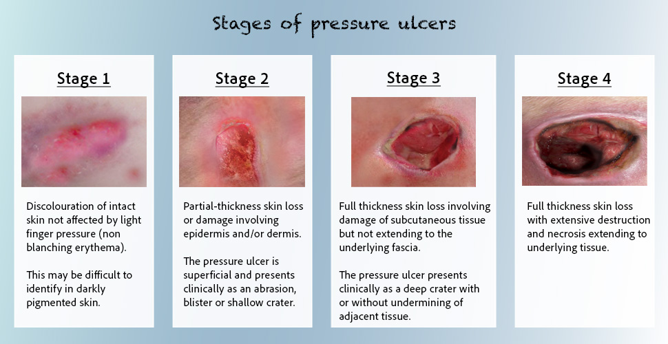 Pressure Ulcer